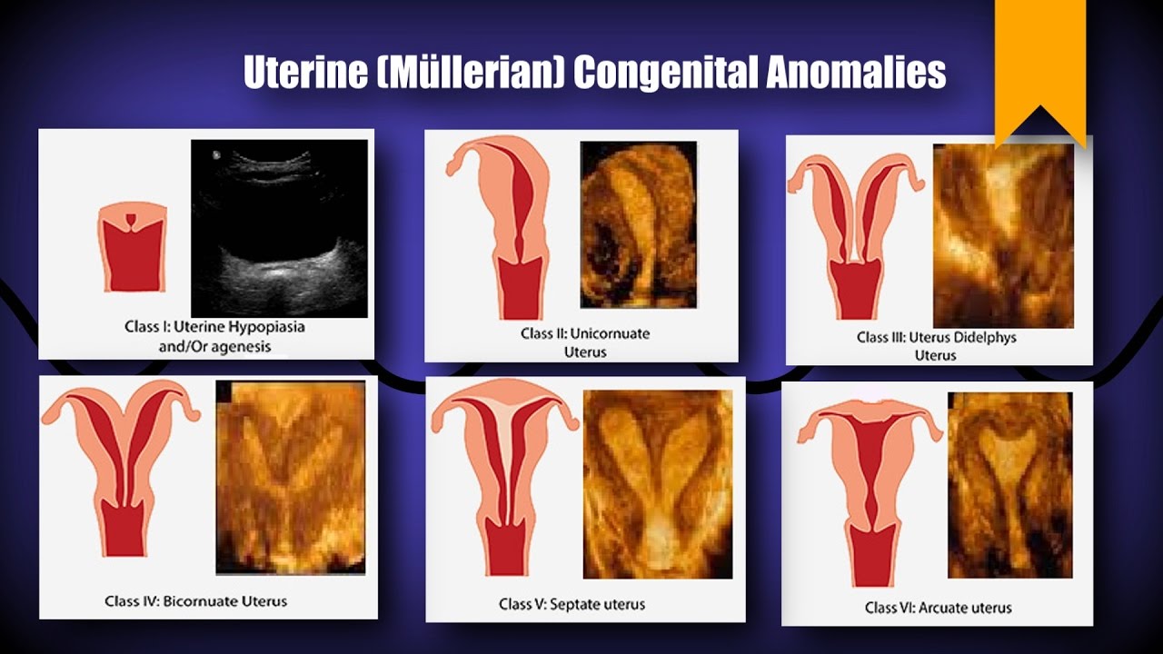 Uterine ( Müllerian) Anomalies