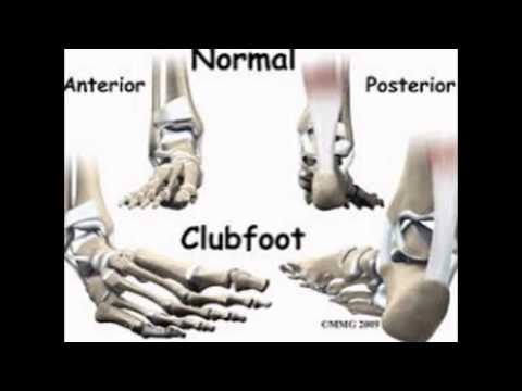 dennis brown shoes for clubfoot & special shoes for clubfoot & best shoes for clubfoot