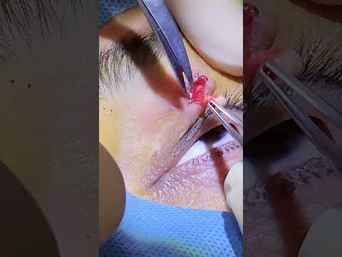 Removal of Epidermal Inclusion Cyst from Eyelids