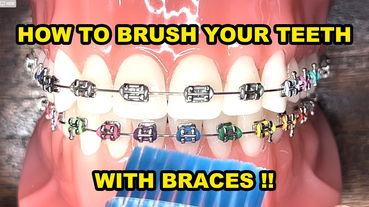 How to Brush your teeth with braces - Full Explanation with close up so you get it right!