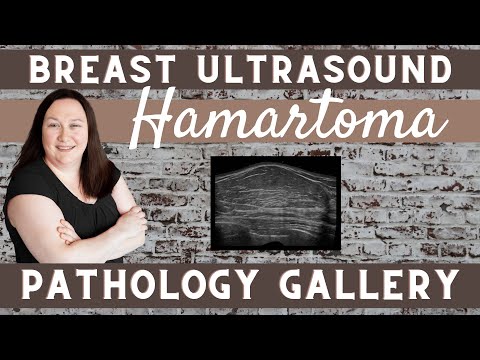 Breast Ultrasound Pathology Gallery | Hamartoma | Sonography Minutes