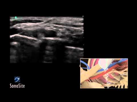 How To: Ultrasound Guided Supraclavicular Nerve Block 3D Video
