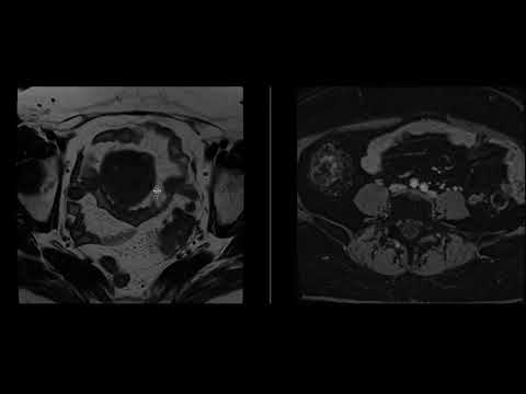 Sigmoid diverticulitis