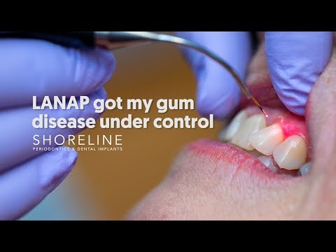Treat periodontal disease with less pain. Dr. Urbanski explains the LANAP procedure.