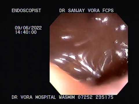 MORE SIGMOIDOSCOPY