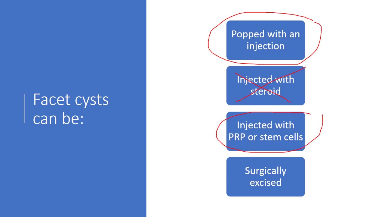 Treatment Options For A Facet Cyst Stem Cell Blog Treatment Options For A Facet Cyst Stem Cell Blog