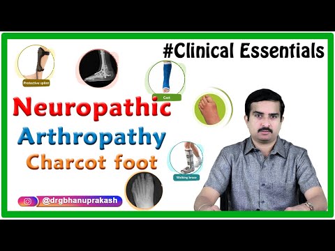 Neuropathic Arthropathy / Charcot foot - Pathogenesis, Diagnosis, Treatment : Dr G Bhanu Prakash