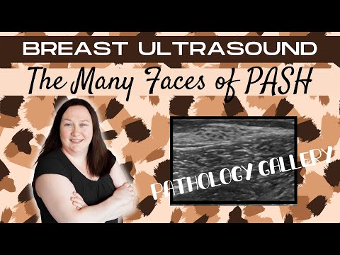 Breast Ultrasound Pathology Gallery | The Many Faces of PASH