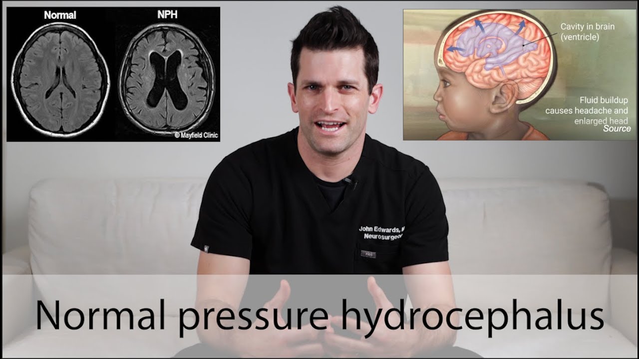 Normal Pressure Hydrocephalus \\ everything you need to know