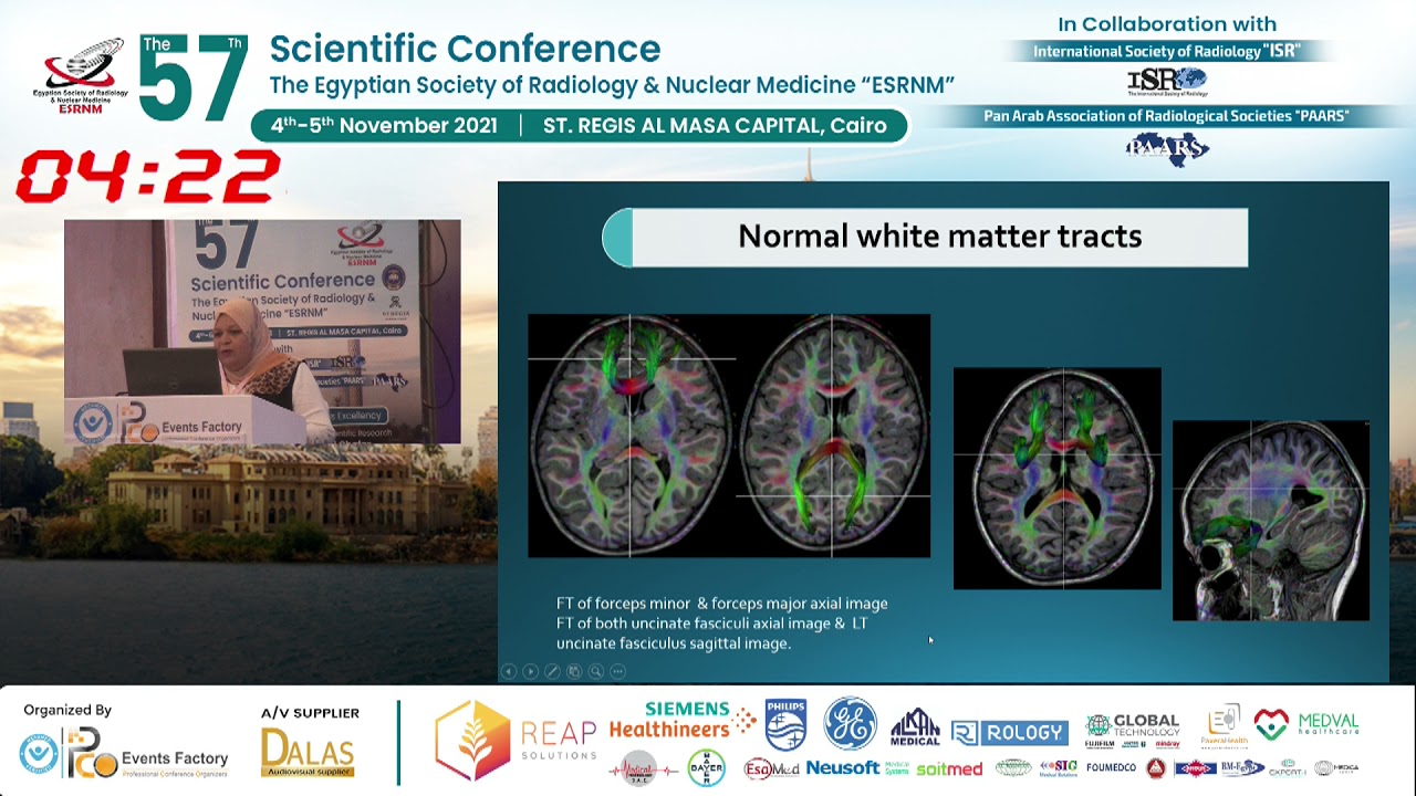 Diffusion Tensor Imaging and fiber Tractography in Pediatric