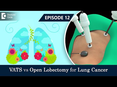 VATS Vs OPEN LOBECTOMY For Effective Lung Cancer Treatment | Dr.Sandeep Nayak & Dr. Sreekanth Reddy