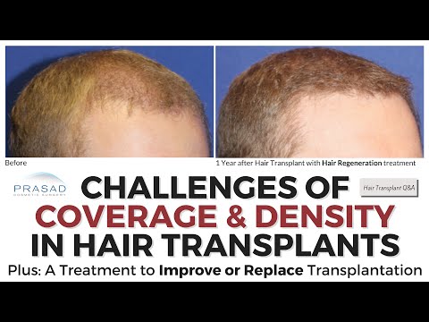 How Successful Hair Transplants are Measured, and Why Hair Density is Best Achieved Non-Surgically