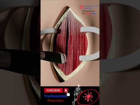 Tracheostomy procedure ???? tracheotomy surgery Annotated Version. #medicalanimation