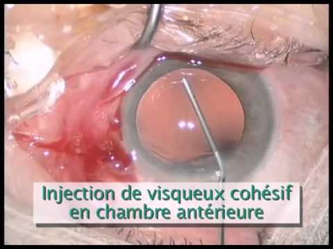 Cirugía de implantación una lente 'Bag in the lens' 89A de FCI