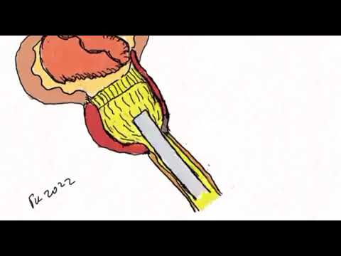 HOLEP(Holmium laser enucleation of prostate)