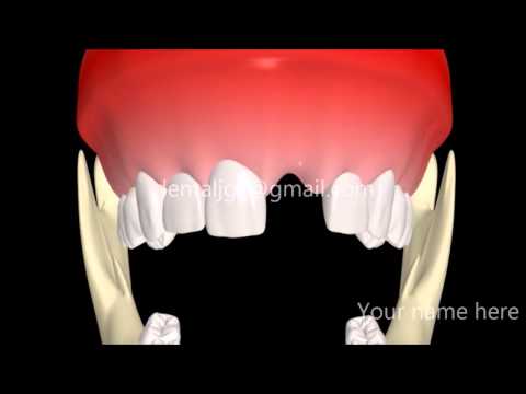 Mental protuberance graft (Clinic Package)