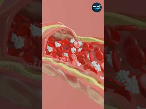 Sugar வந்தா காயம் ஆற late ஆகுறது இதனால்தான்! | Why wound healing takes so long for sugar patients!