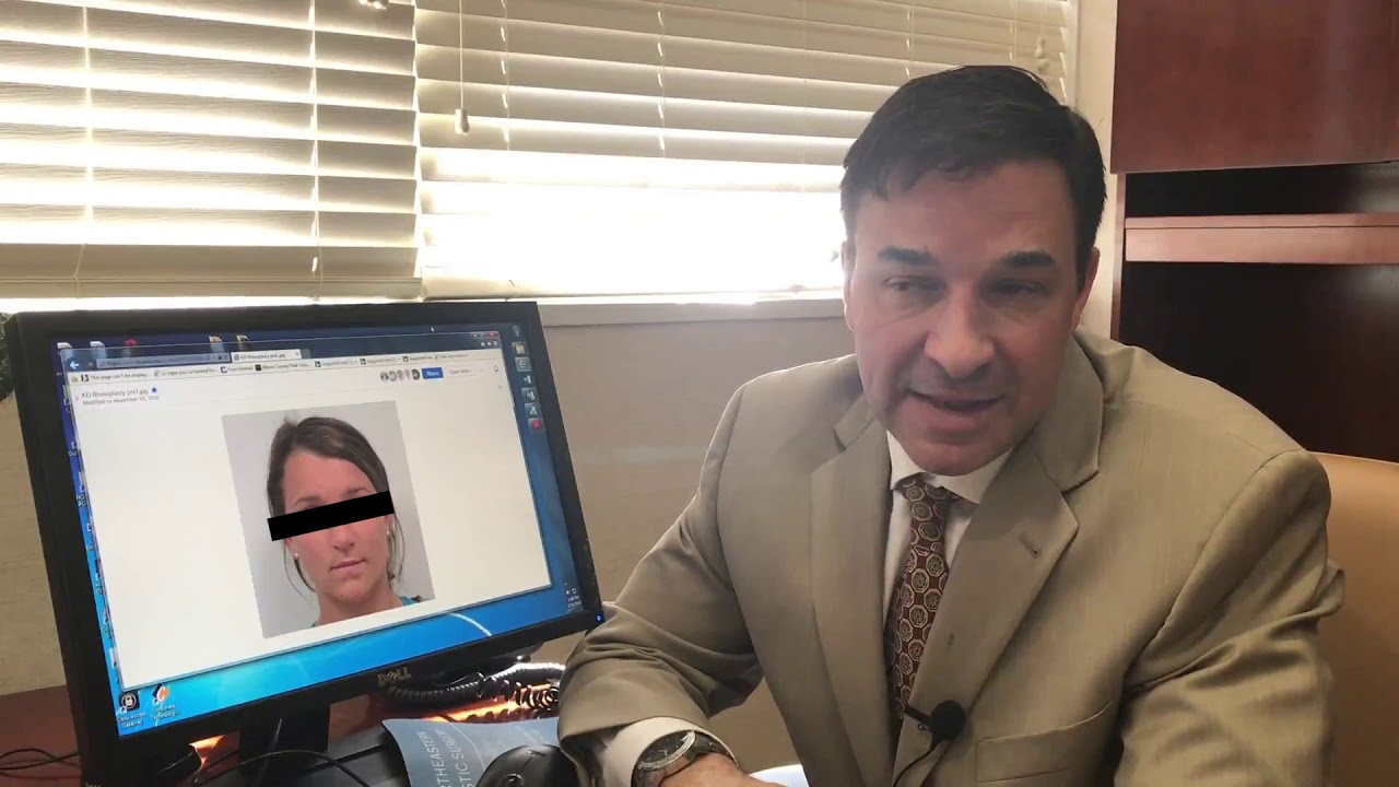 What is the Recovery Process for Revision Rhinoplasty Surgery?