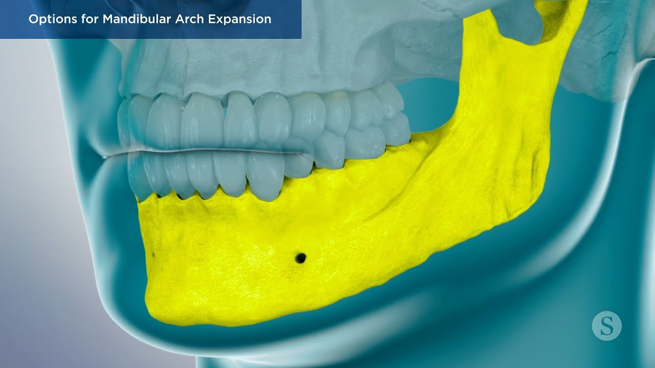 Options for Mandibular Arch Expansion