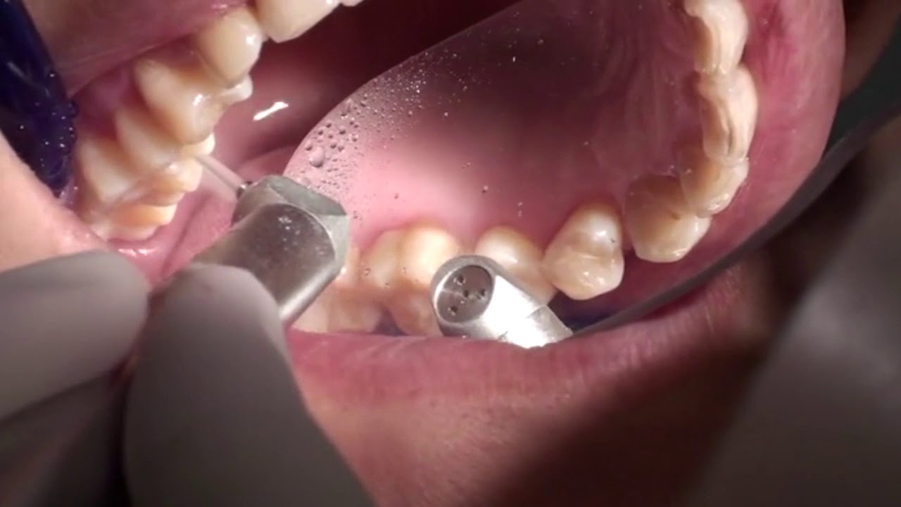 Periodontal Debridement with LIGHTMED's SAPPHIRE LASER