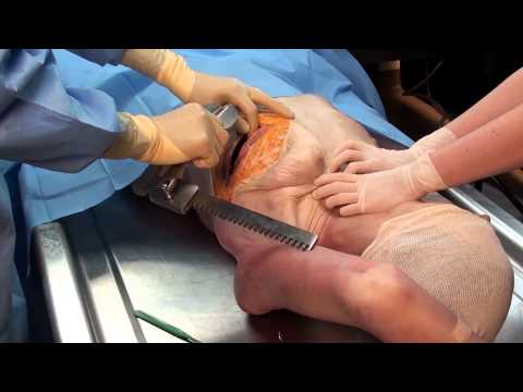 Thoracotomy