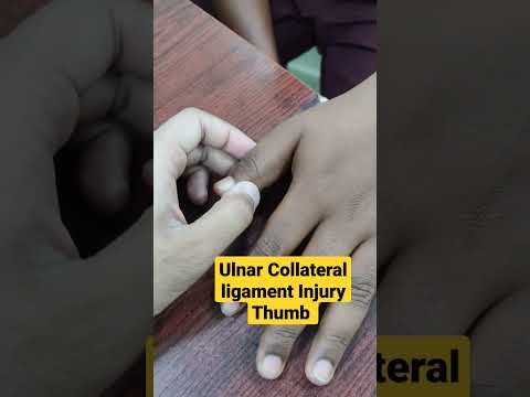 Ulnar Collateral ligament Injury Thumb ..Dr Sai Chandra..#sportssurgeon #kneearthroscopy