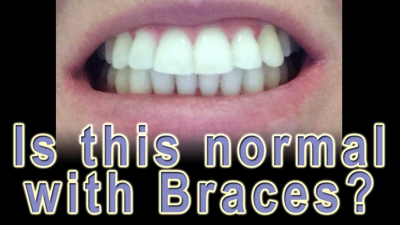 Adult Braces - Should my teeth flare?