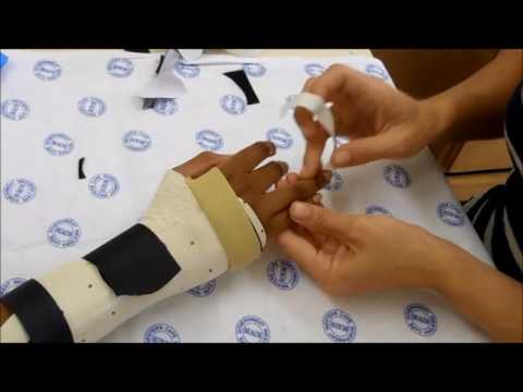 Boxer's Fracture and Mallet finger - conservative management