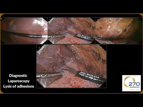 Diagnostic Laparoscopy Lysis of Adhesions