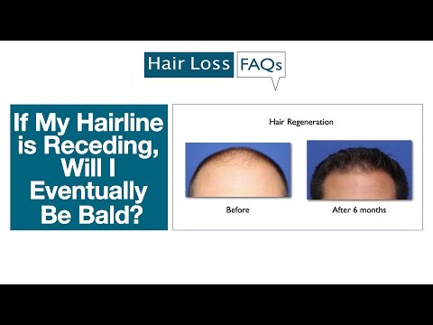 Hair Loss FAQ - If My Hairline is Receding, Will I Eventually be Bald?
