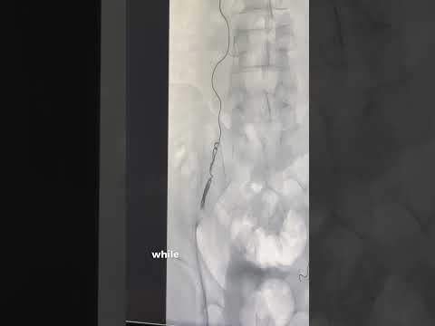 IR - Varicocele Embolization Procedure - Pt2 #doctor #surgicaleducation #generalsurgery #medstudent