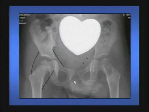 35 Pediatric Bone Lesions