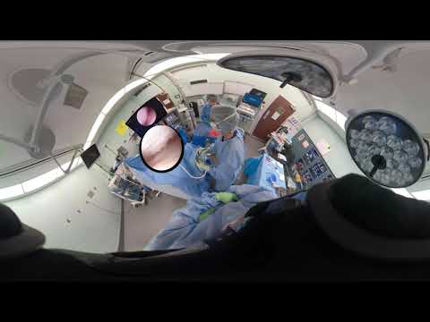 Left Knee Arthroscopy, Diagnostic Scope, Chondroplasty and Visualization - GoPro Fusion 360