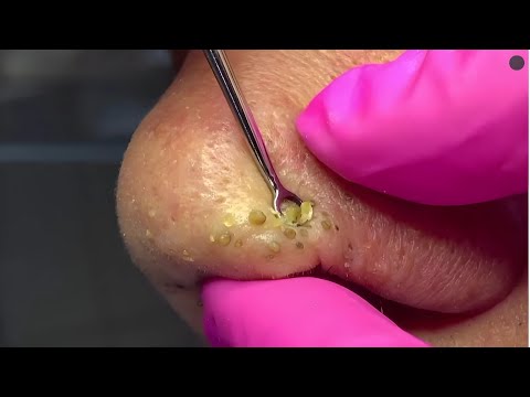 Blackhead Removal: Satisfying Routine | 120