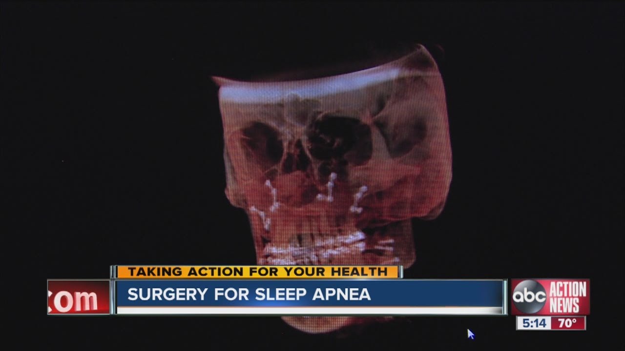 Surgery to correct overbite may be cure for sleep apnea for some