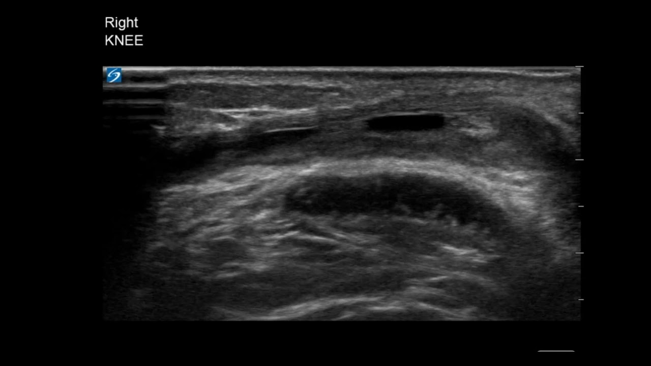 Knee Ultrasound: Infrapatellar Bursitis (Part 1)
