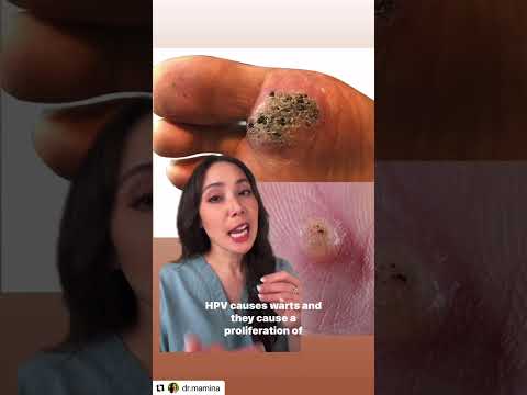 Do Warts Have Seeds?