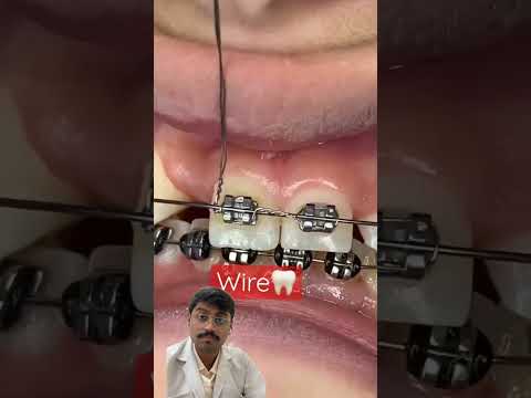 Ligation of teeth! #orthodontics #dentistry #fixed #dentistryworld #orthodontic