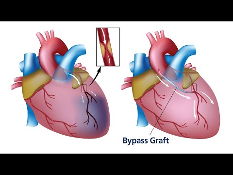 CPT code for bypass graft with vein - simplify medical coding