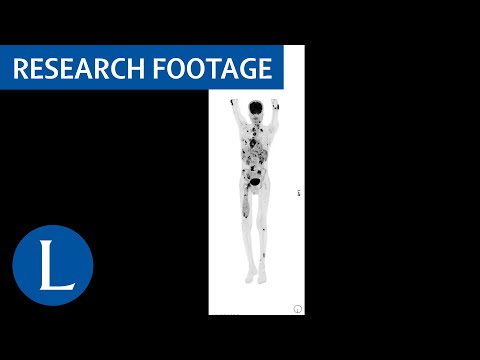 18F-FDG PET with CT in patient 5: video 2 of 2