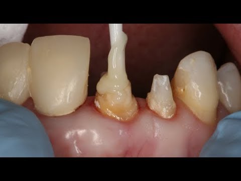 Dental Core Build Up and Post Cementation | Dental Online Training