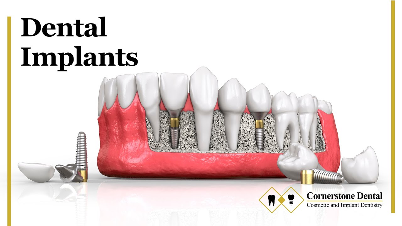 Dental Implants are the Long-Term Solution to Missing Teeth