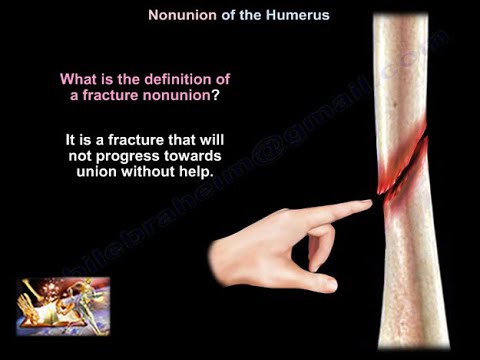 Nonunion of the Humerus - Everything You Need To Know - Dr. Nabil Ebraheim