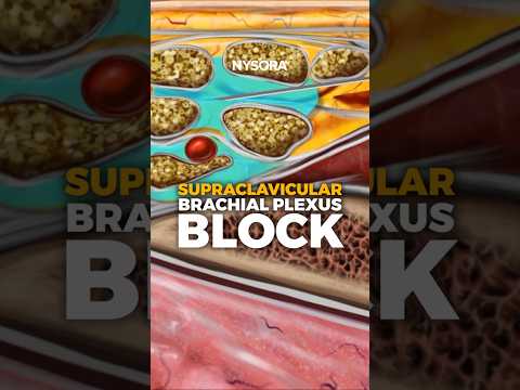Supraclavicular Block: why, how, where, and what's new? #supraclavicular #block