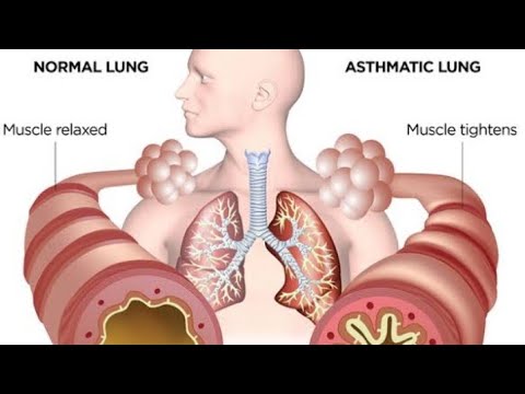 Asthma (Bronchial asthma) in hindi ll Types ll Cause ll Sign & symptoms ll pathophysiology ll CF