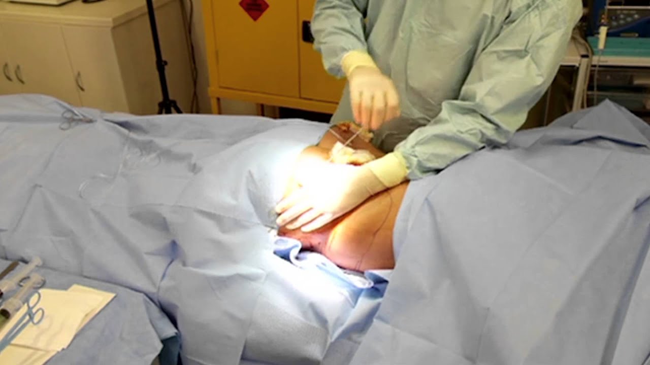 Penoplasty - This Morning