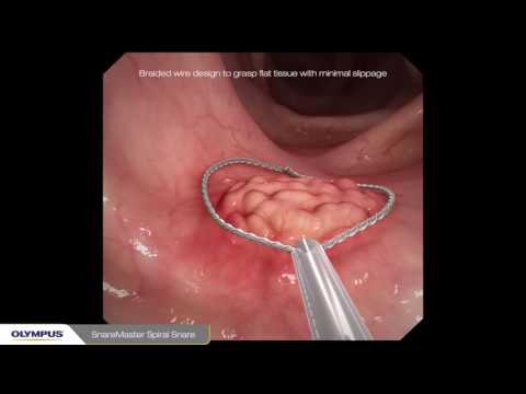 Endoscopic Mycosal Resection (EMR) procedure overview of a sessile polyp using Olympus devices