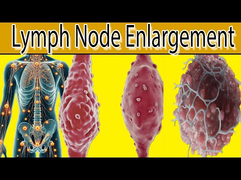 Lymph Node Enlargement - 7 Most common causes