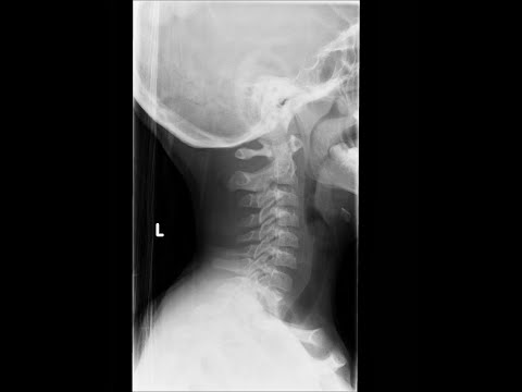 Radiographic Anatomy and Positioning of the Cervical Spine