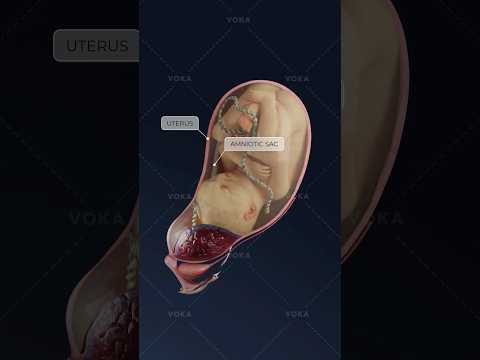 Lateral placental position: what does it mean for your pregnancy? Learn more in 3D with VOKA